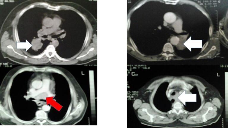 ΑΜΕΣΗ ΔΙΑΓΝΩΣΗ ΚΑΚΟΗΘΕΙΑΣ ΤΟΥ ΠΝΕΥΜΟΝΑ ΜΕ ΤΗΝ ΤΕΧΝΙΚΗ ROSE (RAPID ON ...